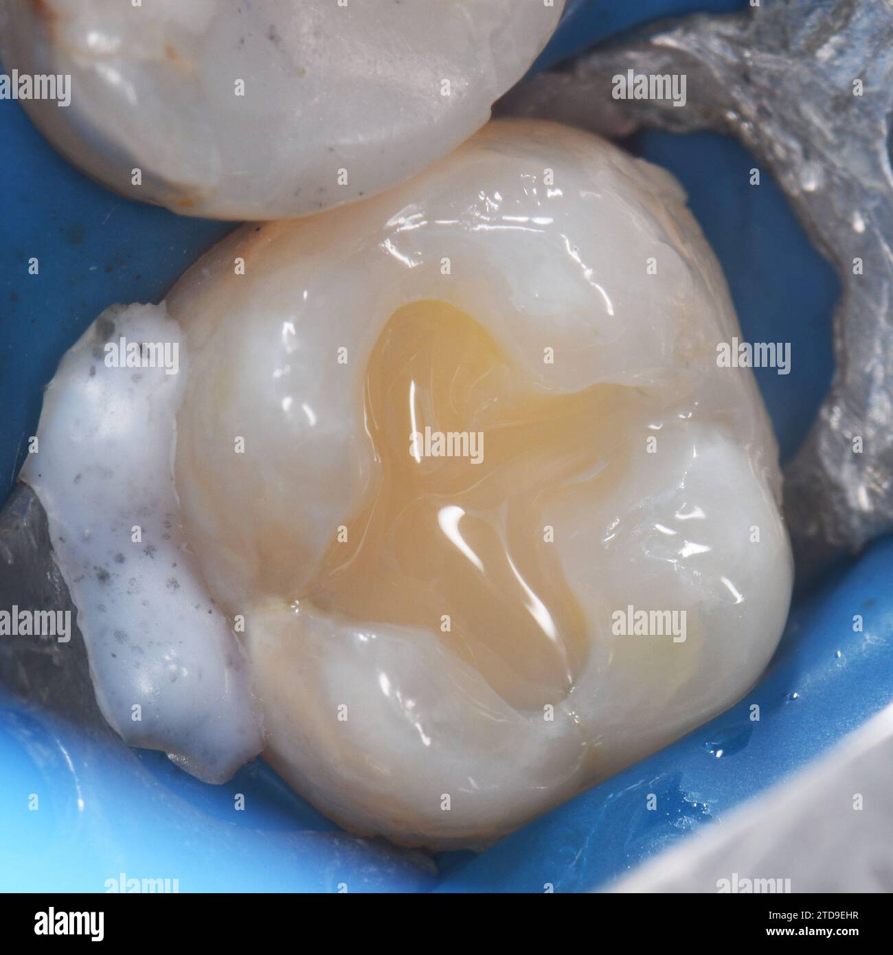 teeth cavity treatment by composite fillings Stock Photo - Alamy