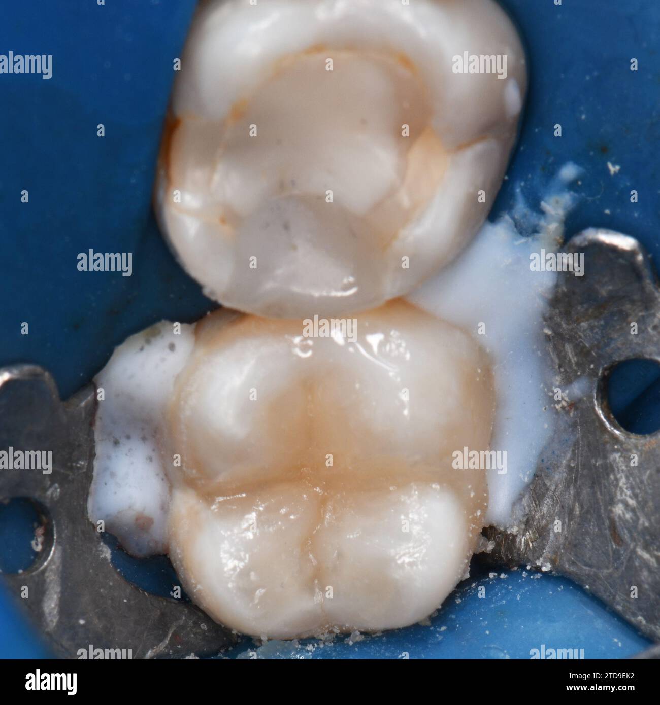 teeth cavity treatment by composite fillings Stock Photo - Alamy