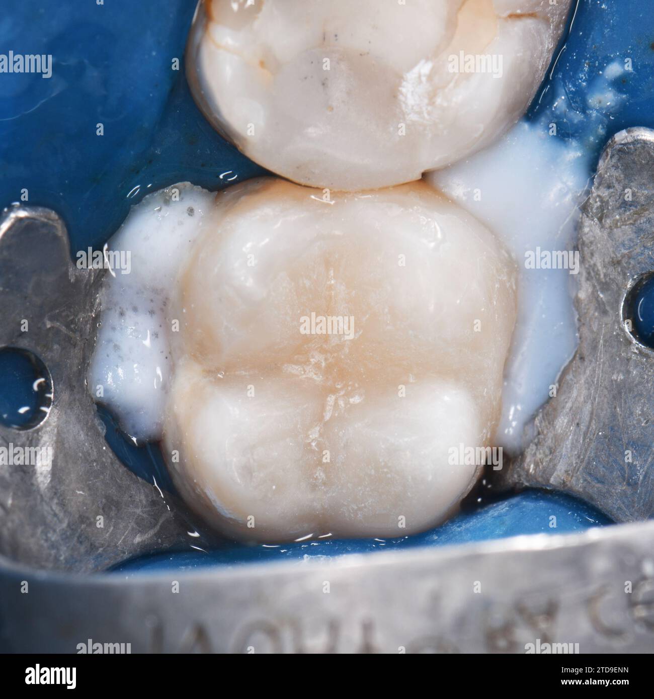 Cavity treatment hi-res stock photography and images - Alamy