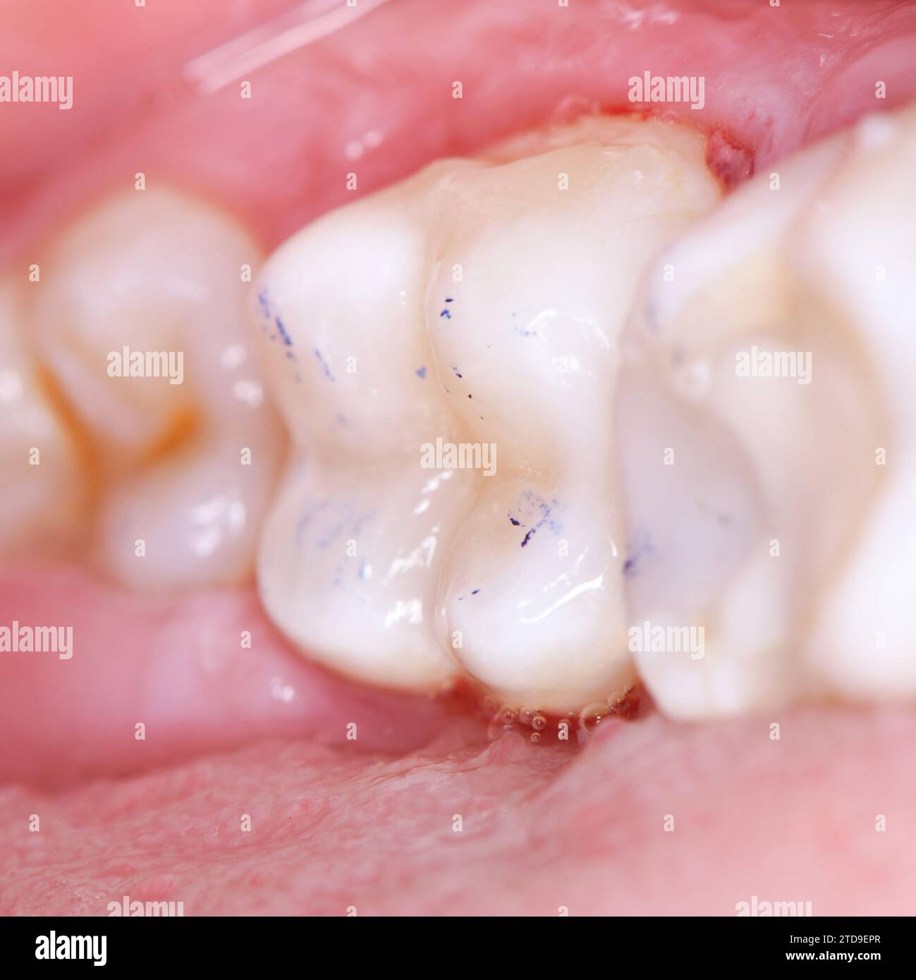 Teeth cavity hi-res stock photography and images - Alamy