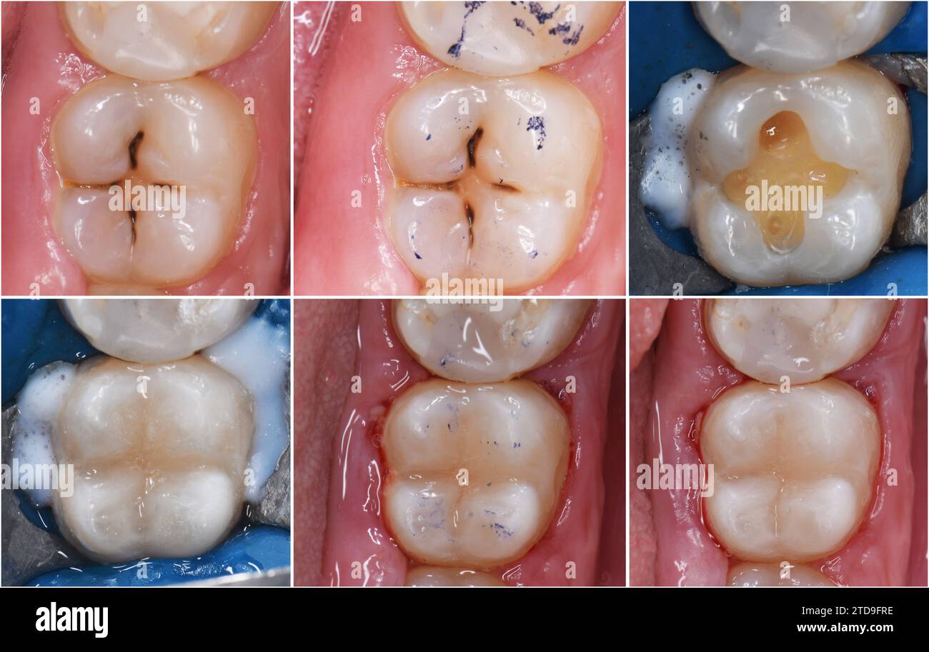 Cavity treatment hi-res stock photography and images - Alamy