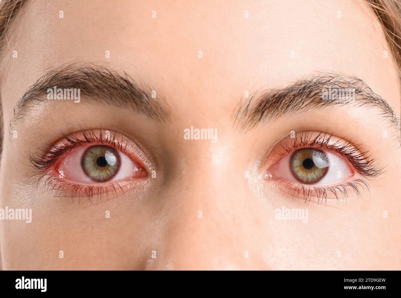 Conjunctivitis discomfort hi-res stock photography and images - Alamy
