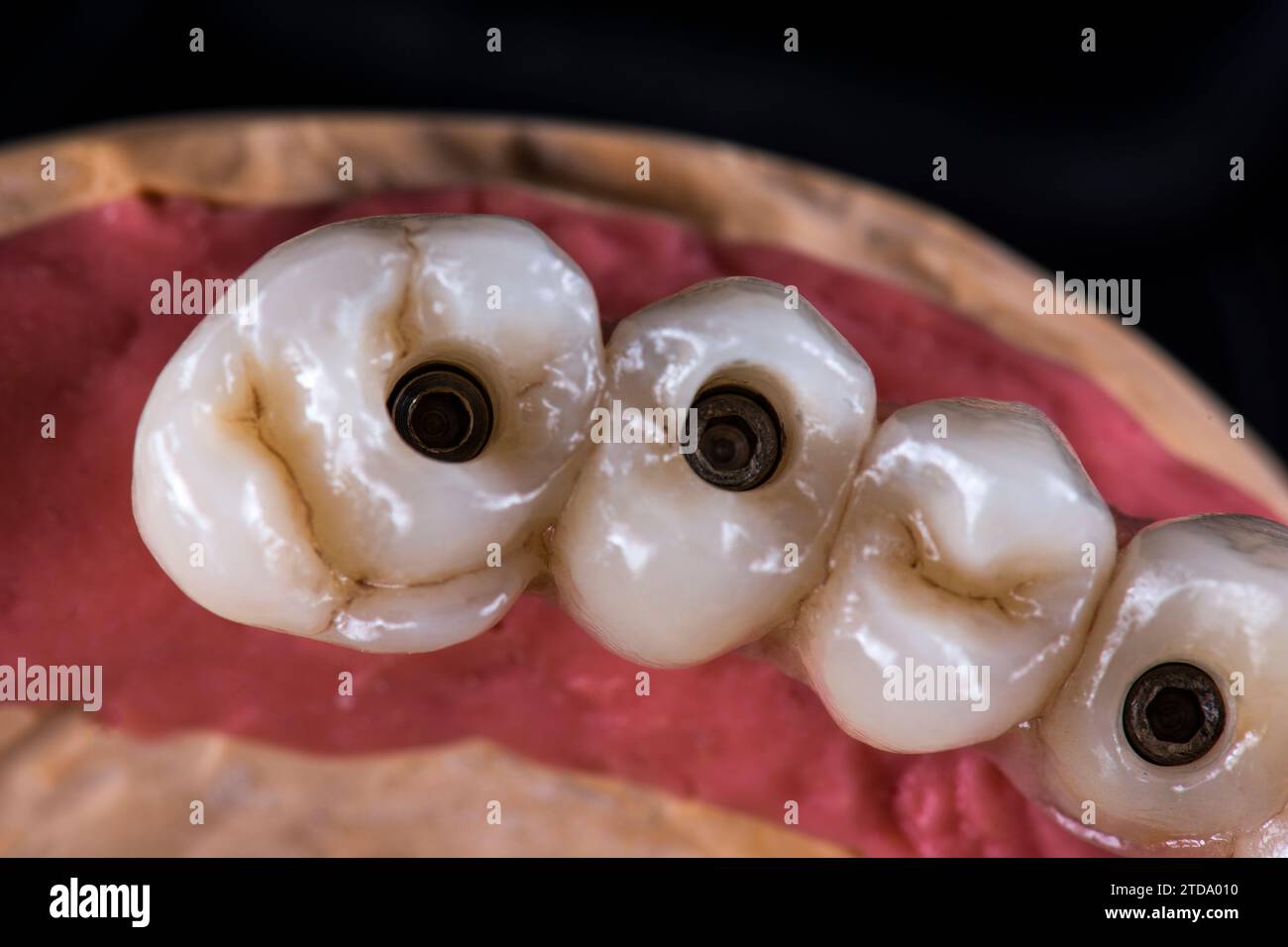 ceramic bridge on implants Stock Photo - Alamy