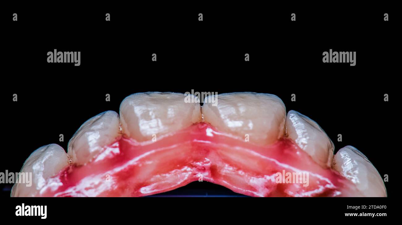 ceramic bridge on implants Stock Photo - Alamy