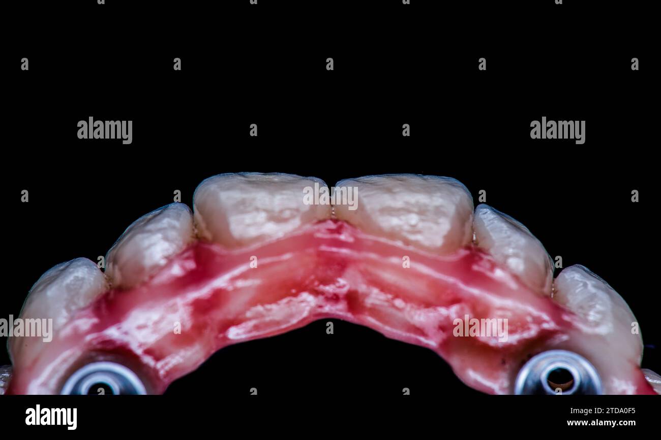 ceramic bridge on implants Stock Photo - Alamy