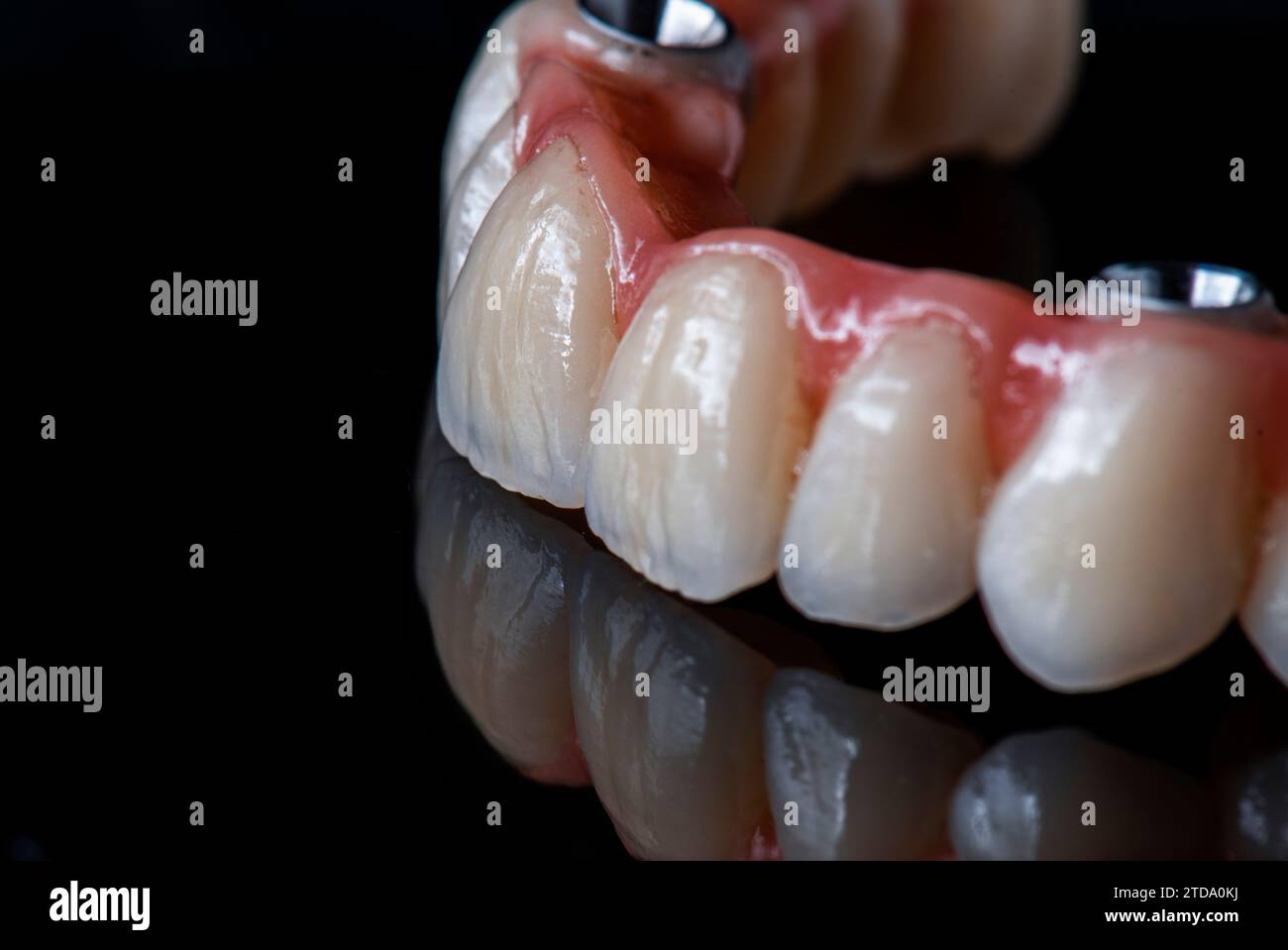 ceramic bridge on implants Stock Photo - Alamy