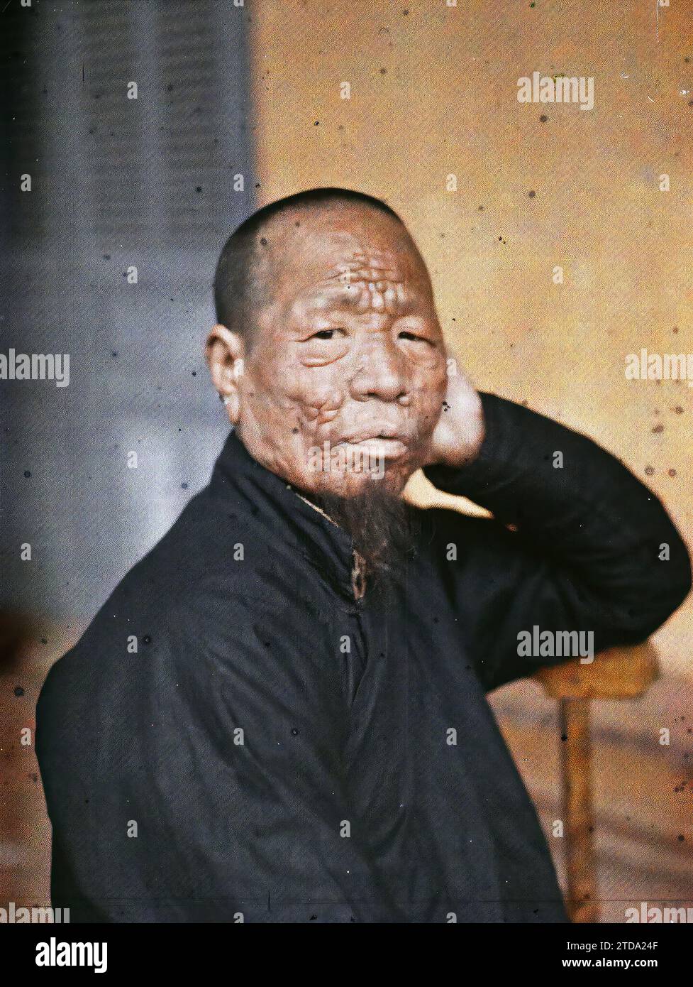 Yên-duyên, Tonkin, Indochina A leper in a leper colony in Du' ô' ng-té ...