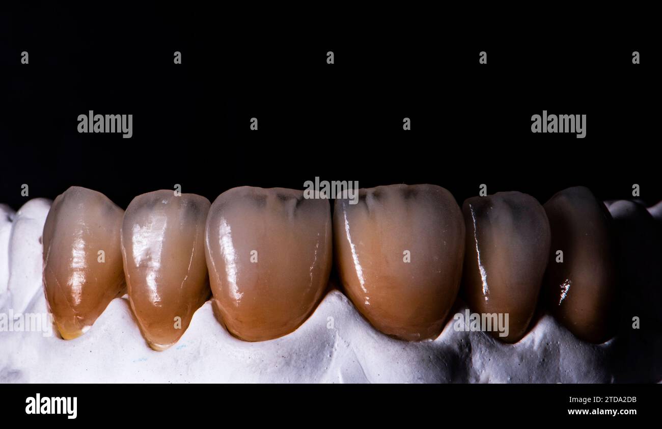 ceramic bridge on implants Stock Photo - Alamy