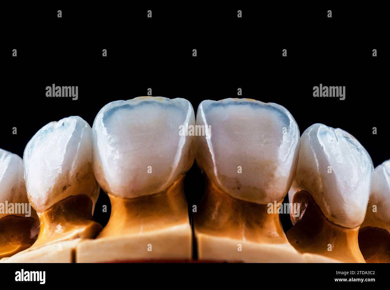 ceramic bridge on implants Stock Photo - Alamy