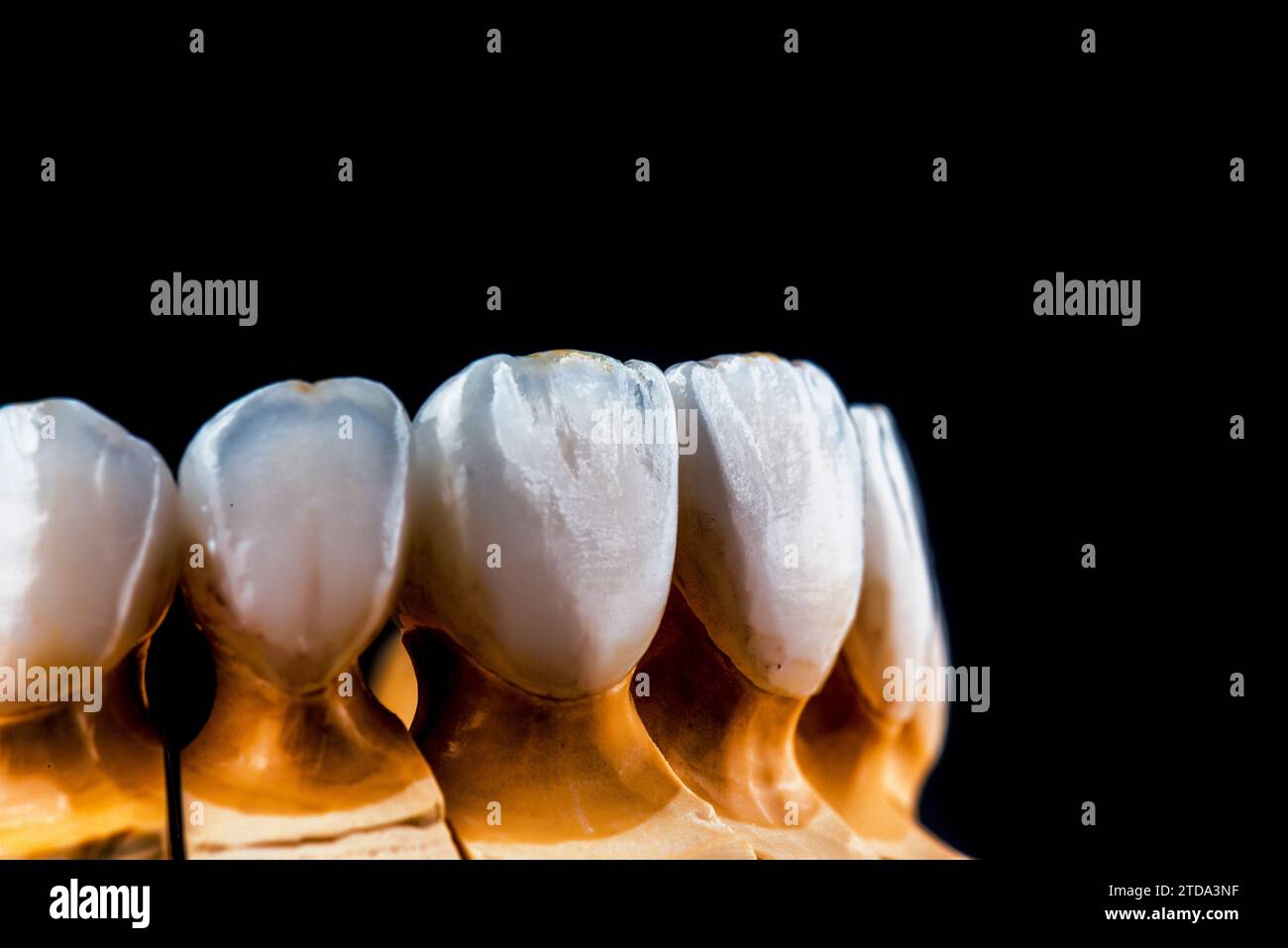 ceramic bridge on implants Stock Photo - Alamy