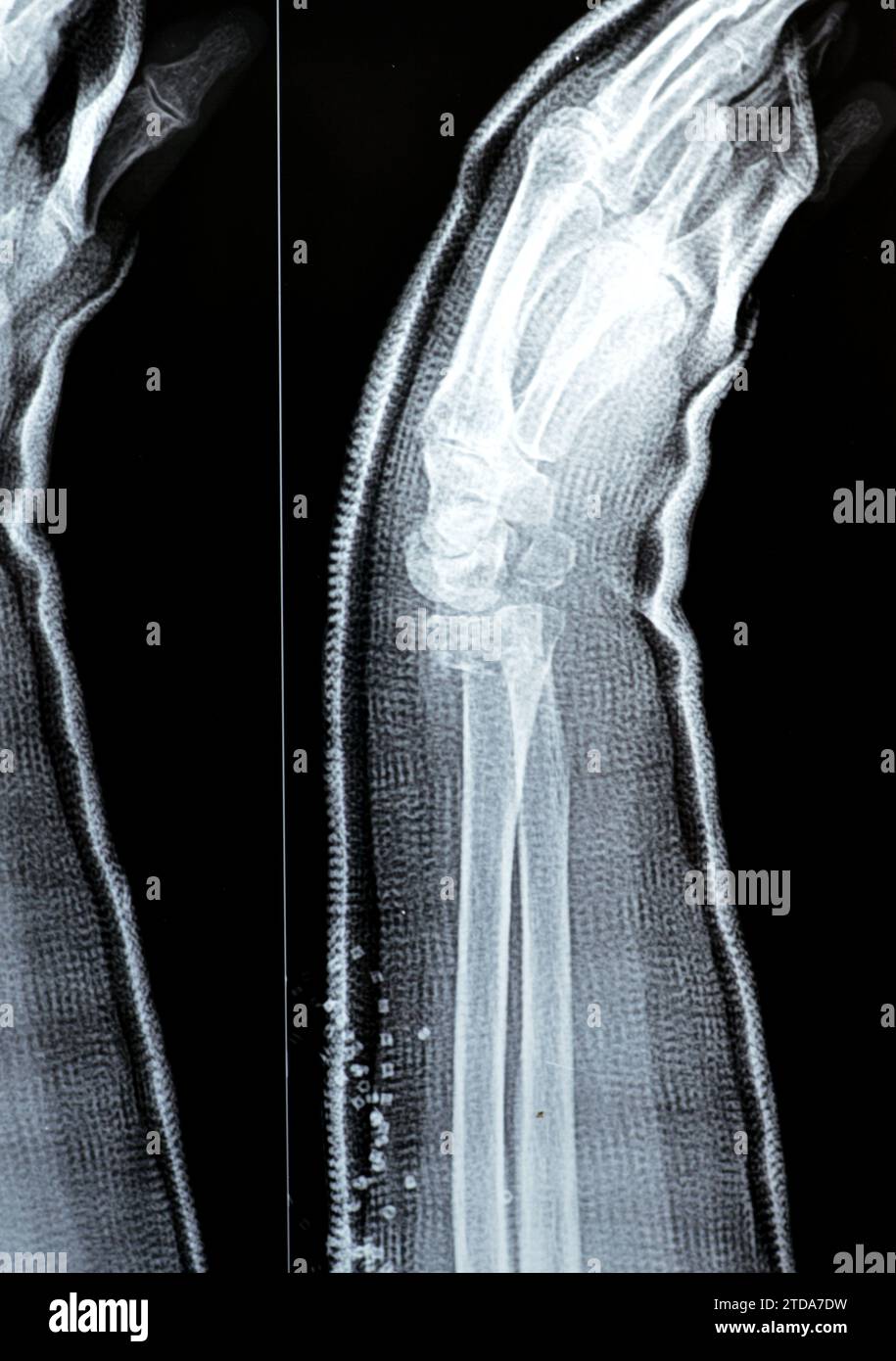 Colles Fracture Reduction Of An Old Female A Type Of Fracture Of The