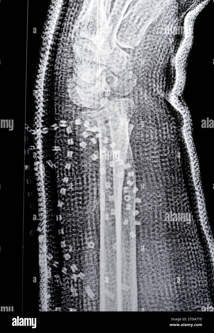 Colles fracture healing of an old female, a type of fracture of the ...