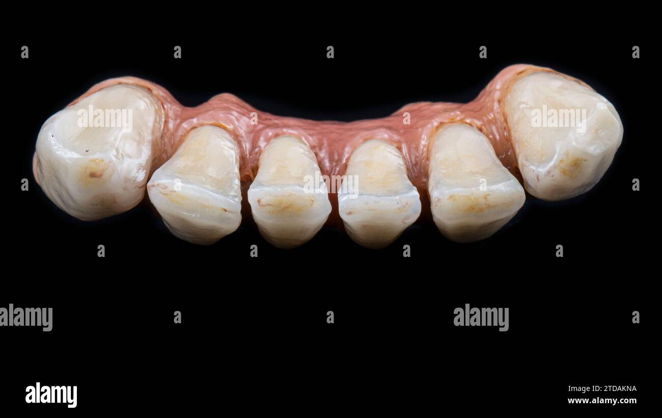 natural look dental bridge Stock Photo - Alamy