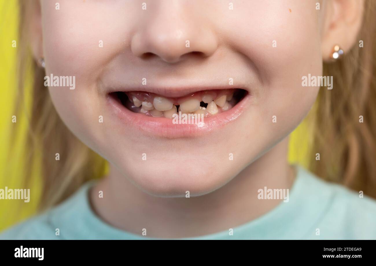 Smiling mouth of a girl with uneven growing molars and baby teeth ...