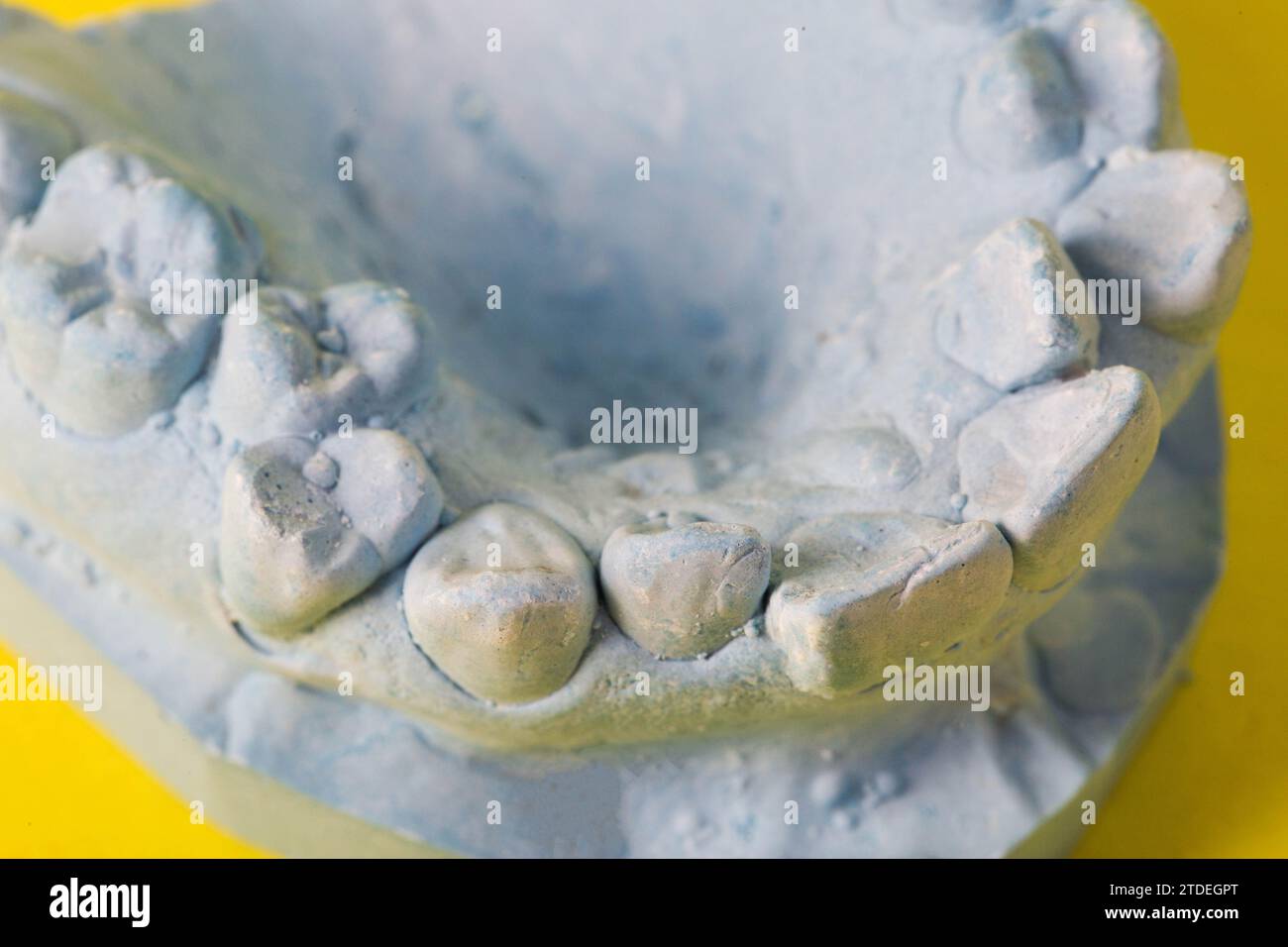 Blue plaster model of an impression of a patient s jaw at an ...