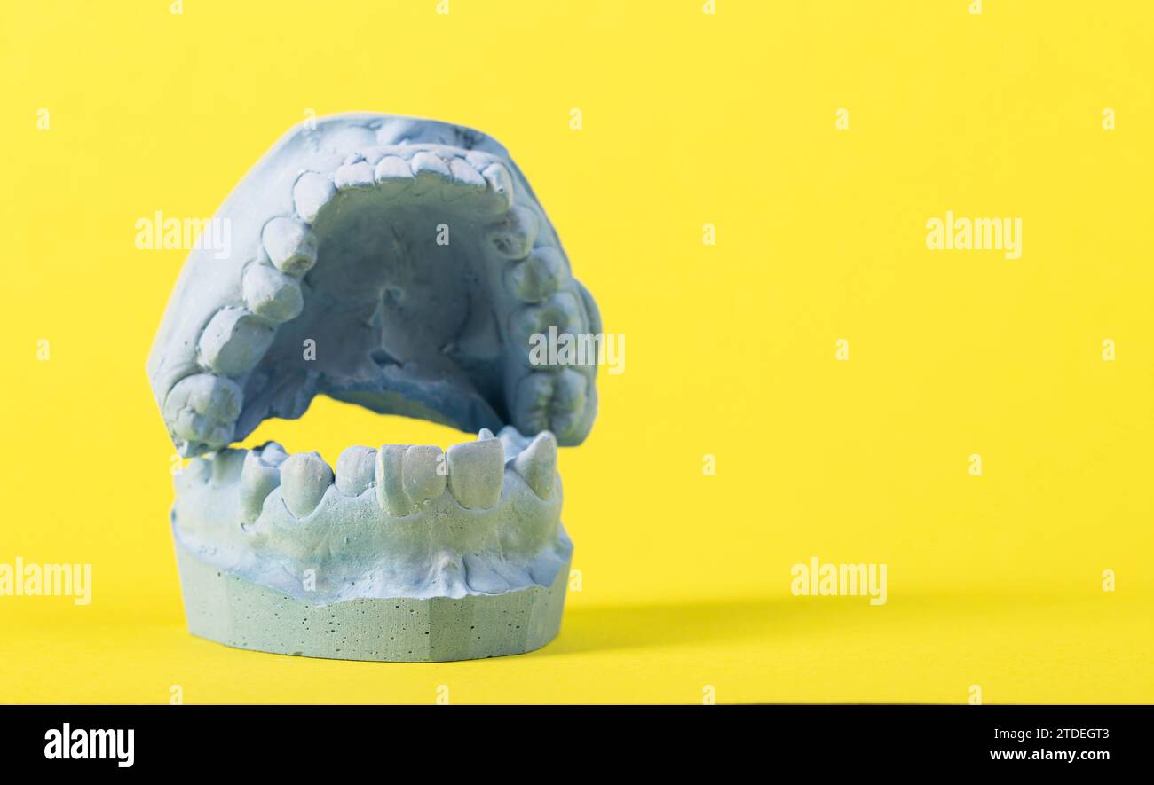 Blue plaster impression of a patient's dental jaw with crooked teeth ...