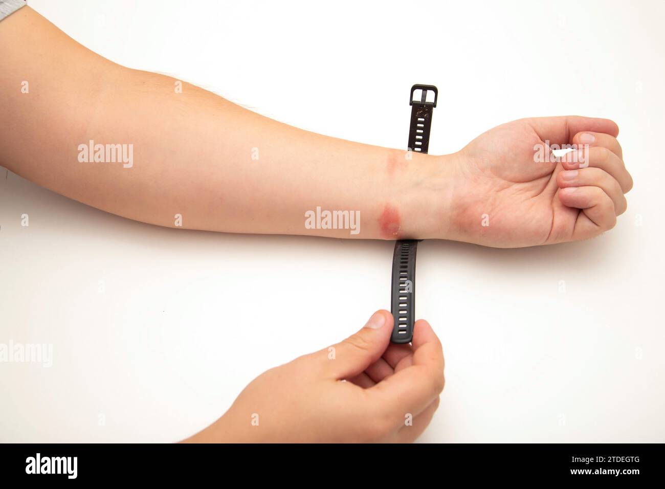 Irritation, redness and itching on the skin after wearing a watch or ...