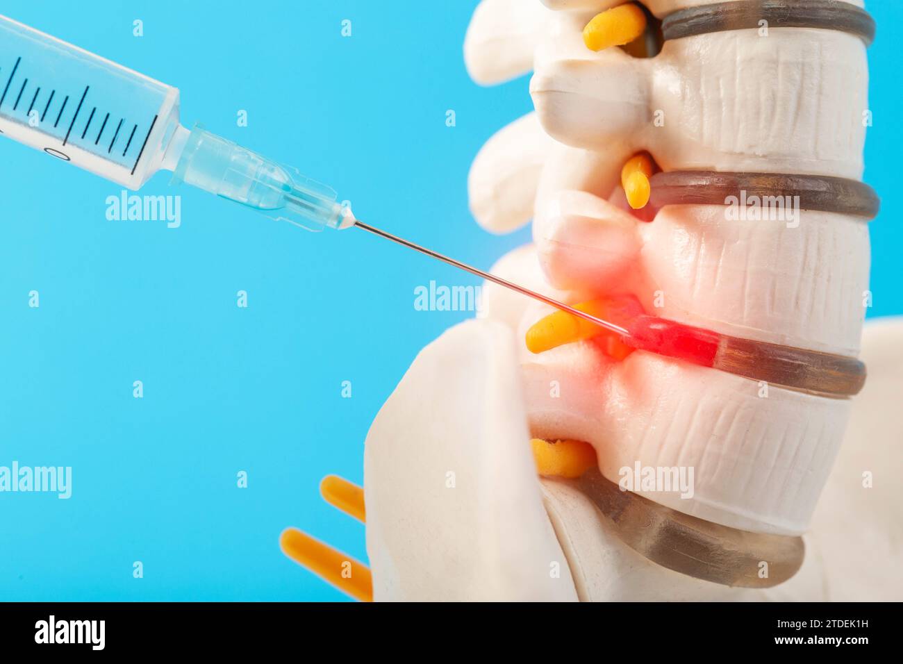Lumbar facet injection hi-res stock photography and images - Alamy