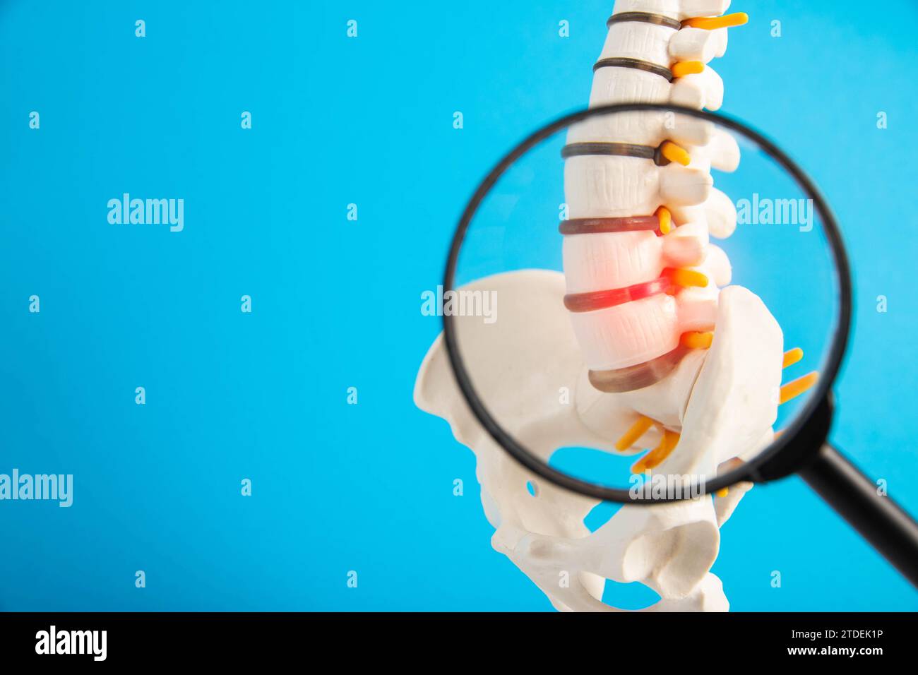 Model of the lumbar spine with a red intervertebral hernia and ...