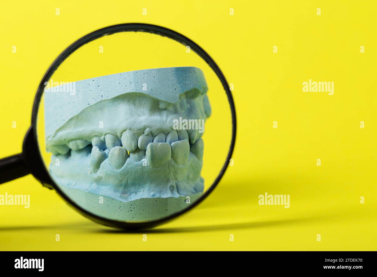 Medical plaster cast of a dental jaw with teeth on a yellow background ...