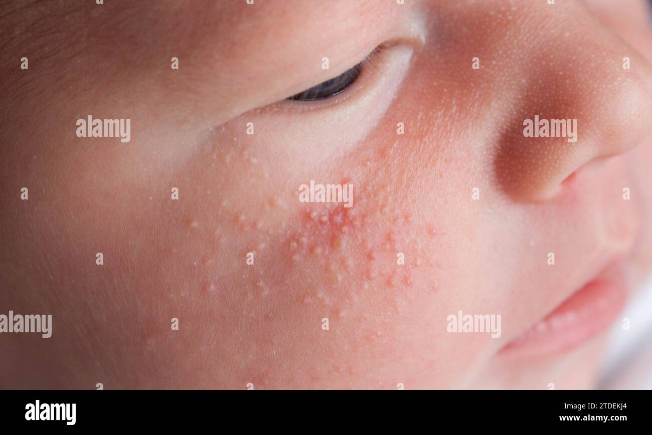Allergic pimples in a newborn on the face. Pathogenesis, acne of ...