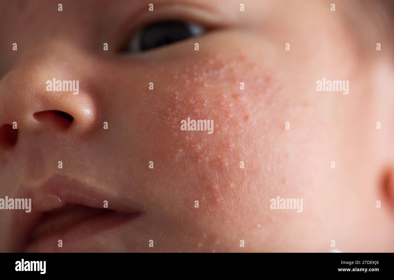 Rash on the face of a newborn baby. The process of formation of the ...