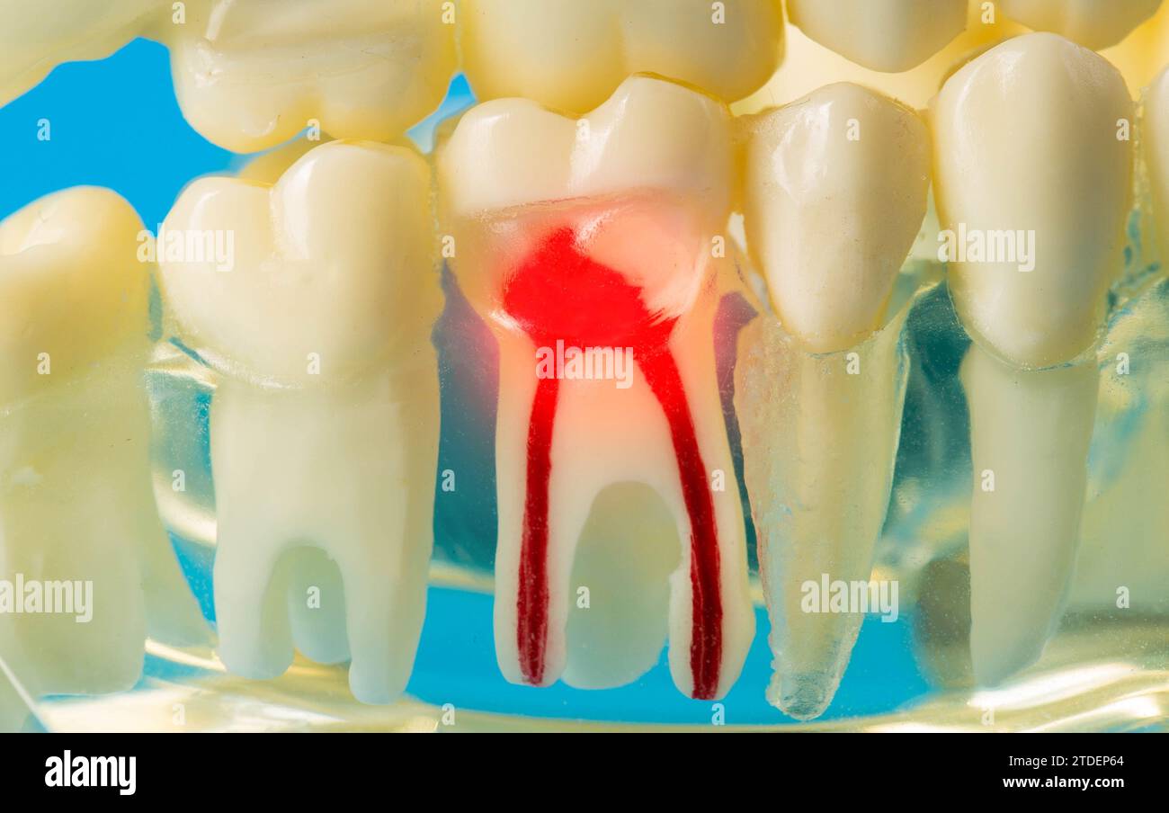Mockup of a dental jaw with diseased teeth. Inflamed tooth canal ...