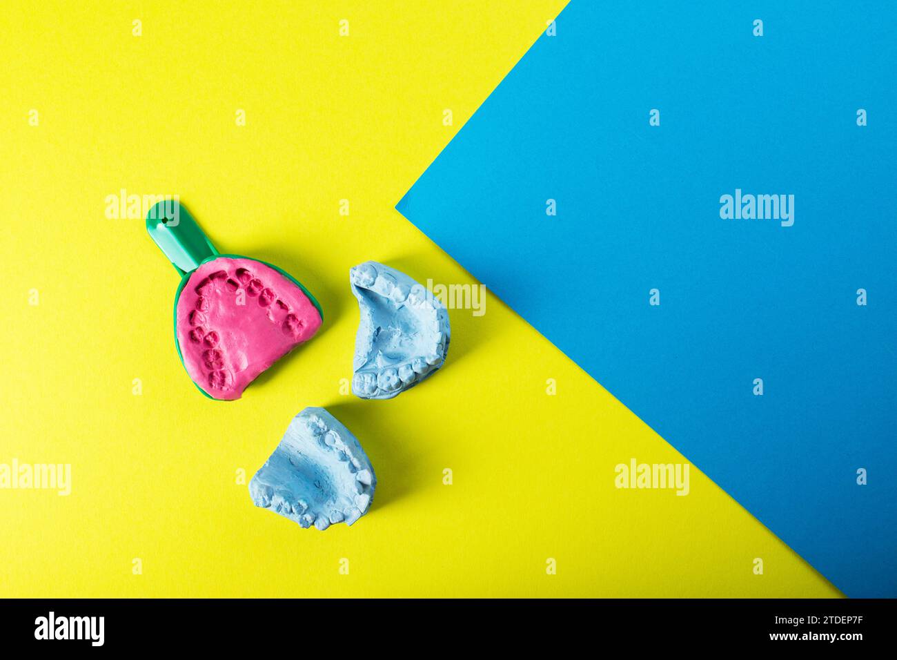 Dental tray with alginate plastic mass and blue plaster jaw of the ...