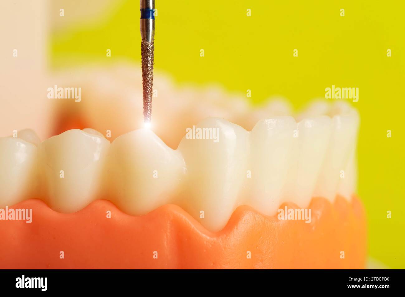 Drilling a diseased tooth with caries with a drill in dentistry during ...