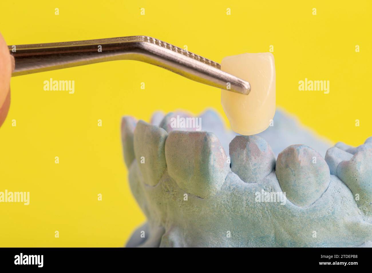 A metal-ceramic dental crown in tweezers against a plaster dental jaw ...