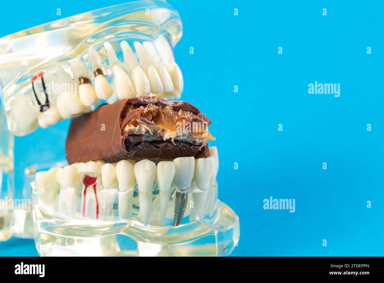 A bitten piece of chocolate in a dental jaw mockup on a blue background ...