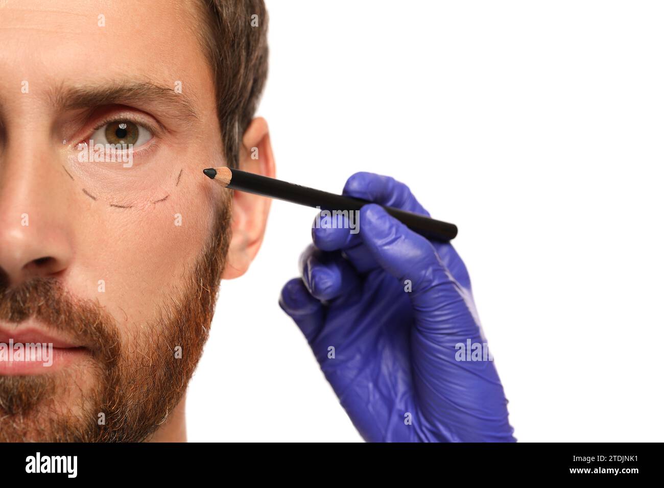 Doctor with pencil preparing patient for cosmetic surgery operation on ...