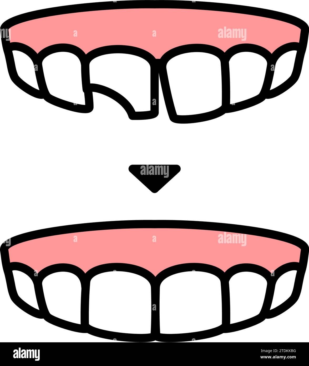 Dentistry: Direct Bonding Before and After, Simple Line Drawing ...
