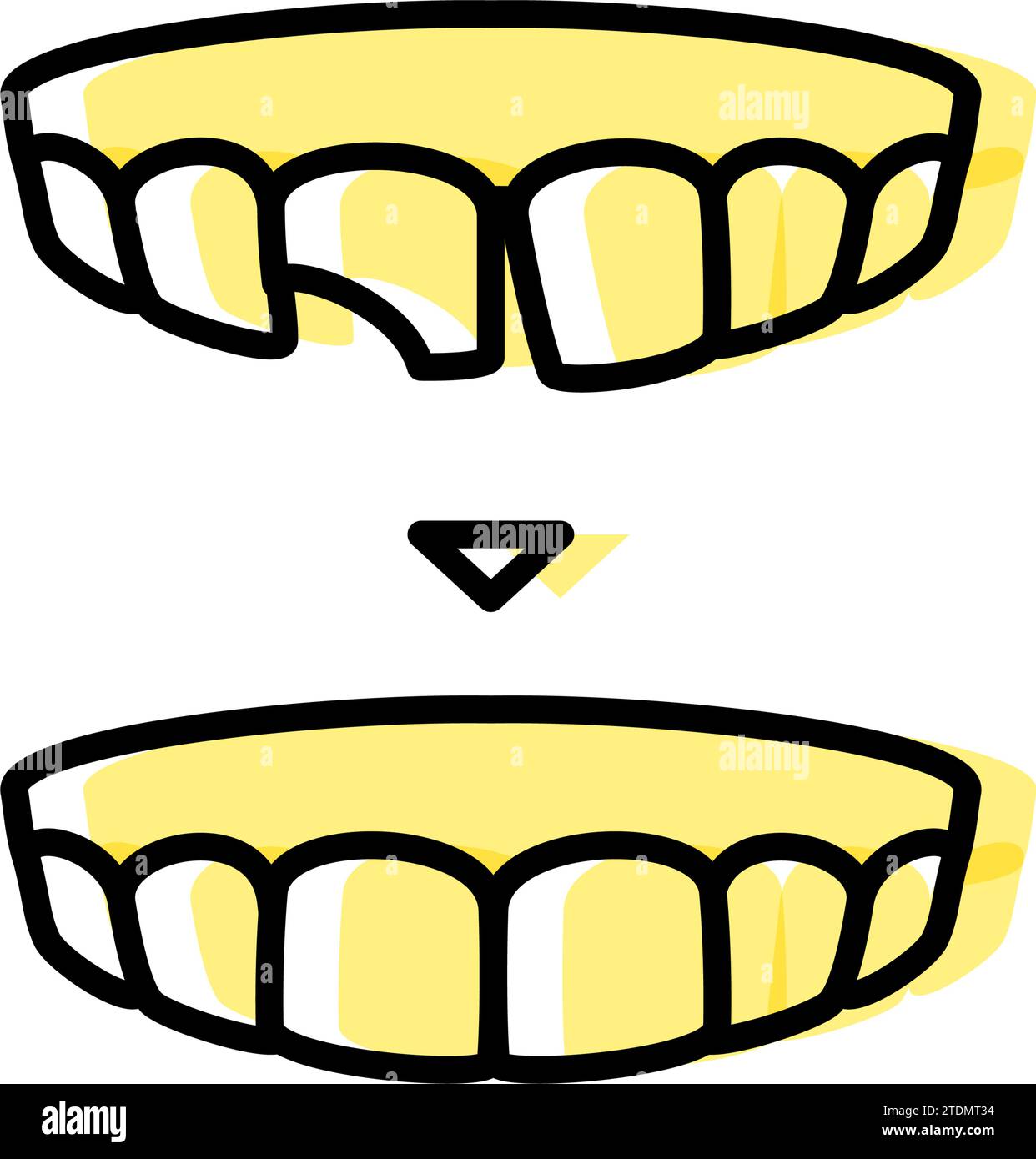 Dentistry: Direct Bonding Before and After, Simple Line Drawing ...