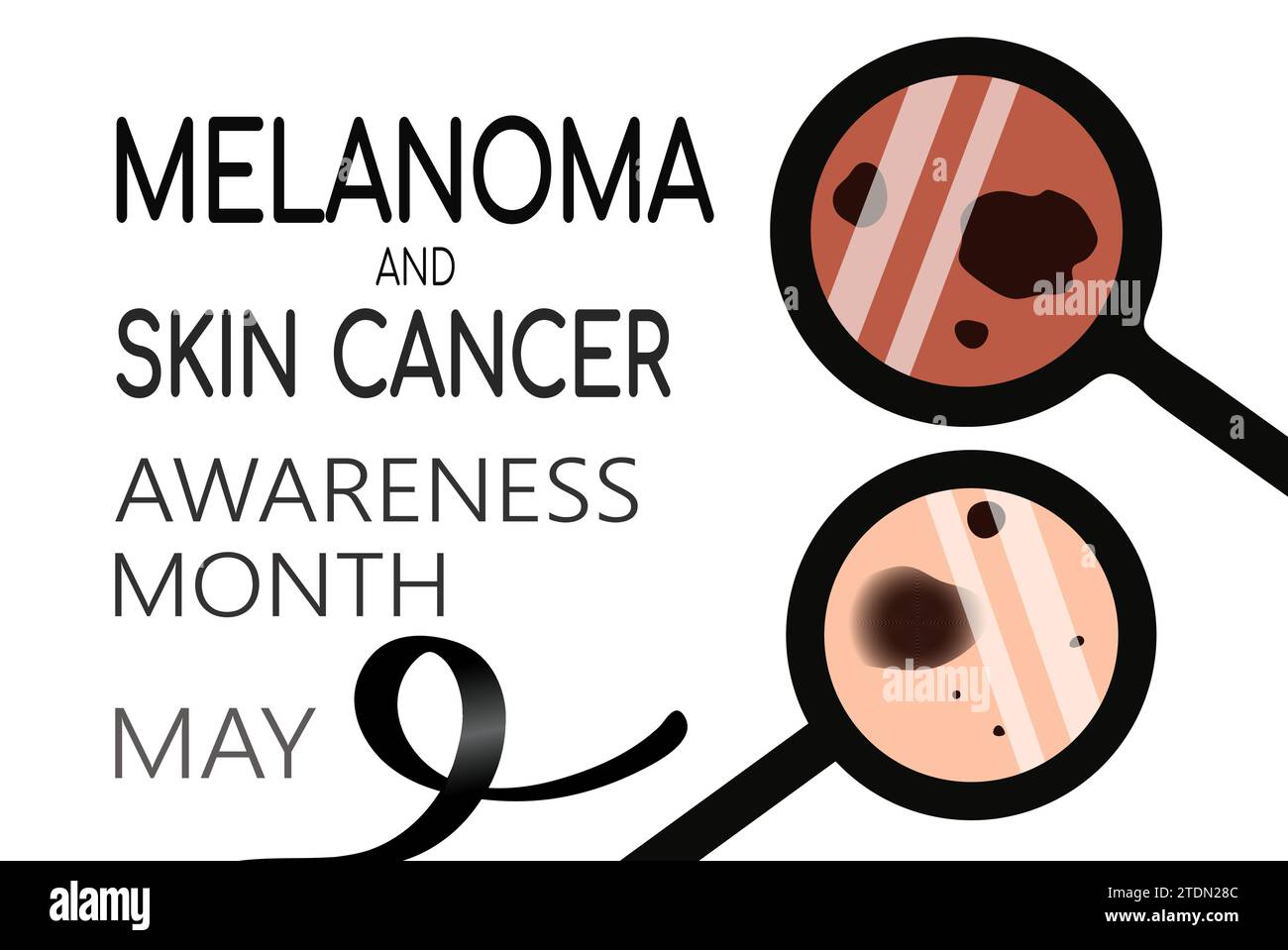 Melanoma mole Stock Vector Images - Alamy