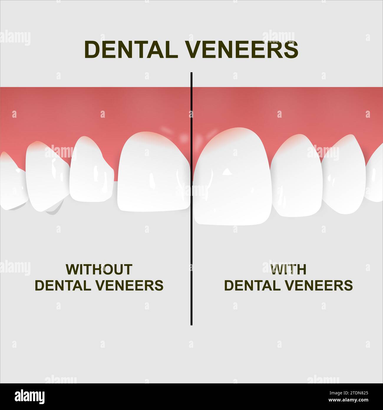 Dental Veneers Illustration Tooth Straightened Demo Stock Photo - Alamy