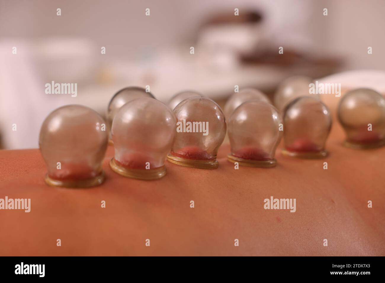 Man cupping therapy on hi-res stock photography and images - Alamy