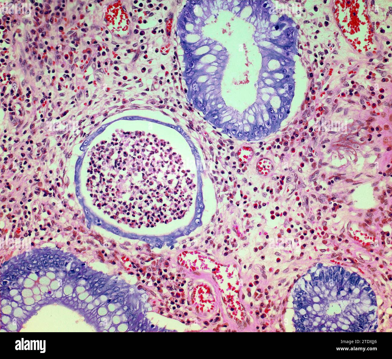 Ulcerative colitis. Light micrograph (LM) of a section through an ...