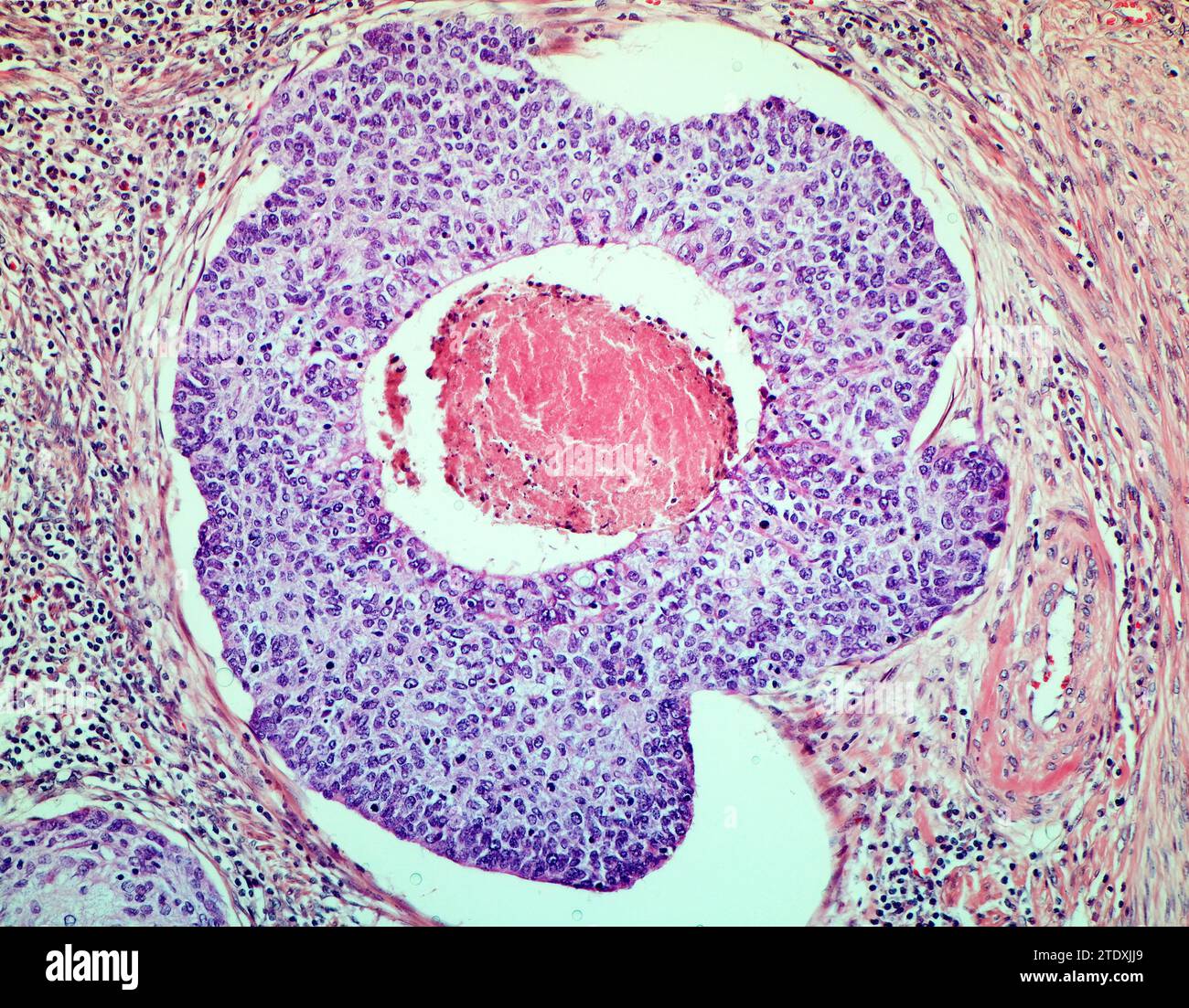 Cervical Cancer Light Micrograph Lm Of A Section Through An Hsil
