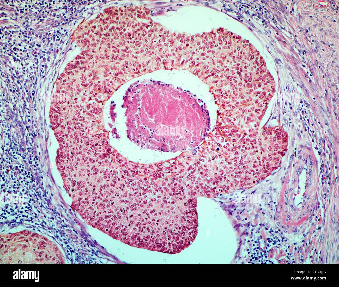 Cervical cancer. Light micrograph (LM) of a section through an HSIL ...