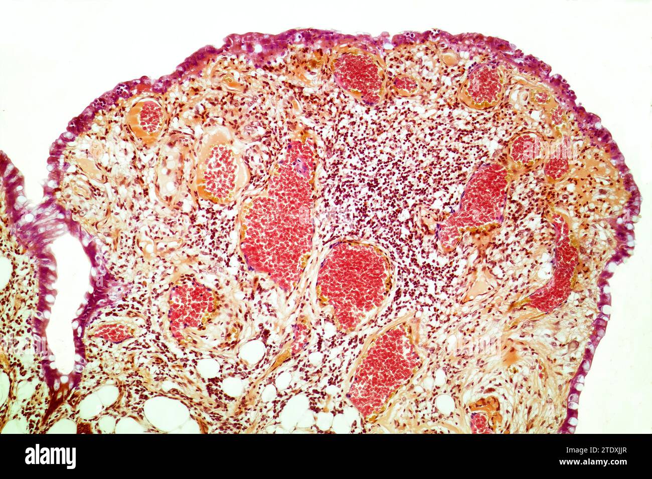 Ulcerative colitis. Light micrograph (LM) of a section through an ...