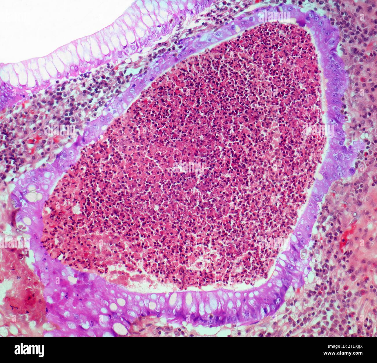 Ulcerative colitis. Light micrograph (LM) of a section through an ...