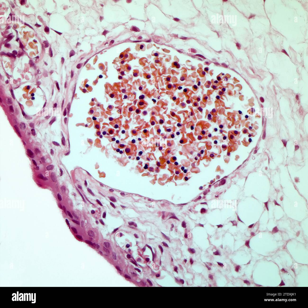 Nucleated red blood cells in placental blood vessels. Light micrograph ...