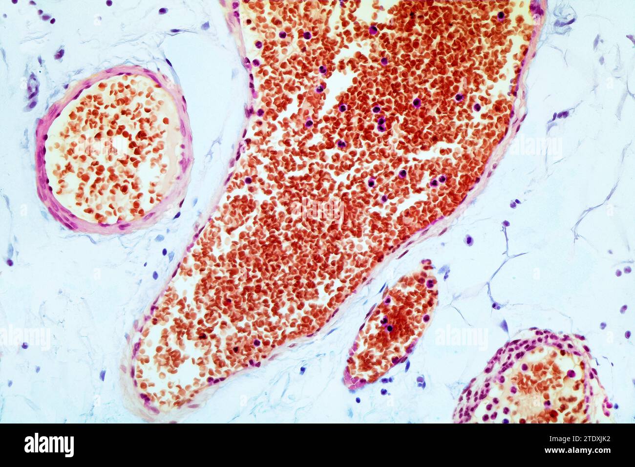 Inflammatory response. Light micrograph of a section through blood ...