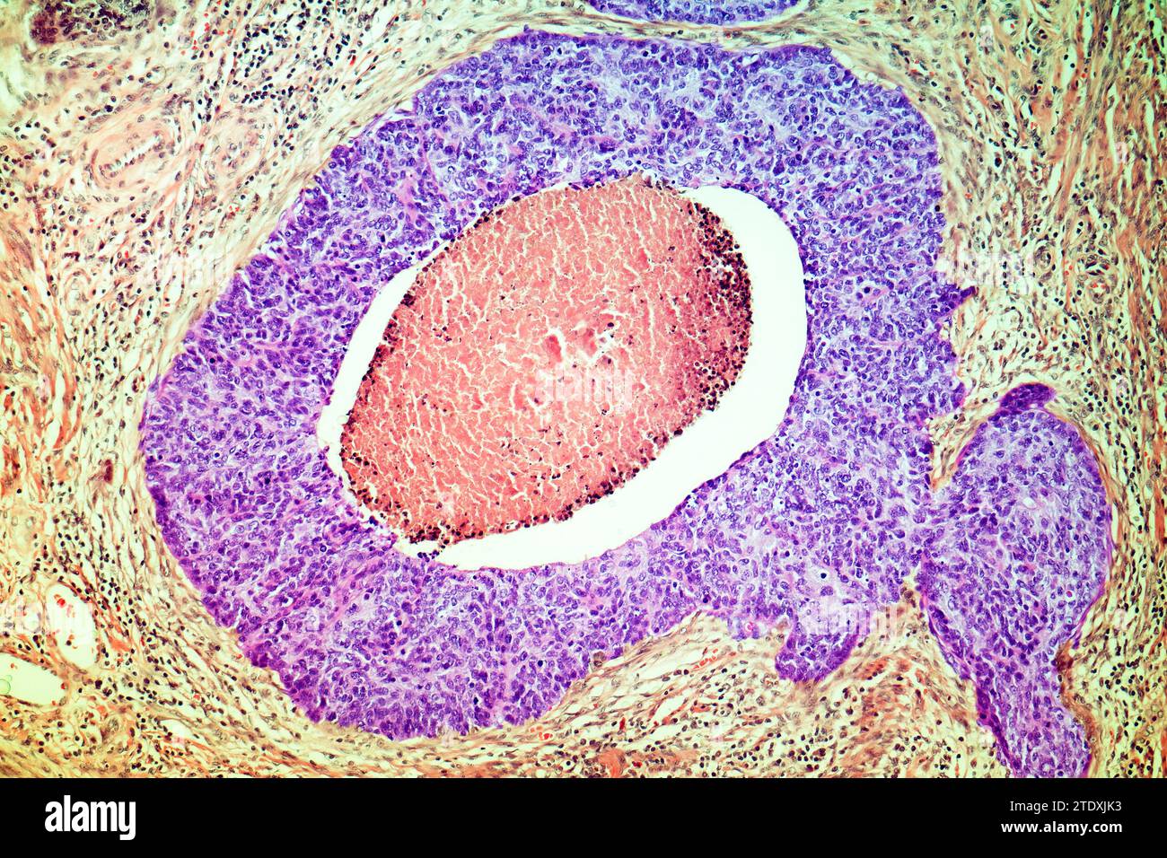 Cervical cancer. Light micrograph (LM) of a section through an HSIL (High-grade squamous ...
