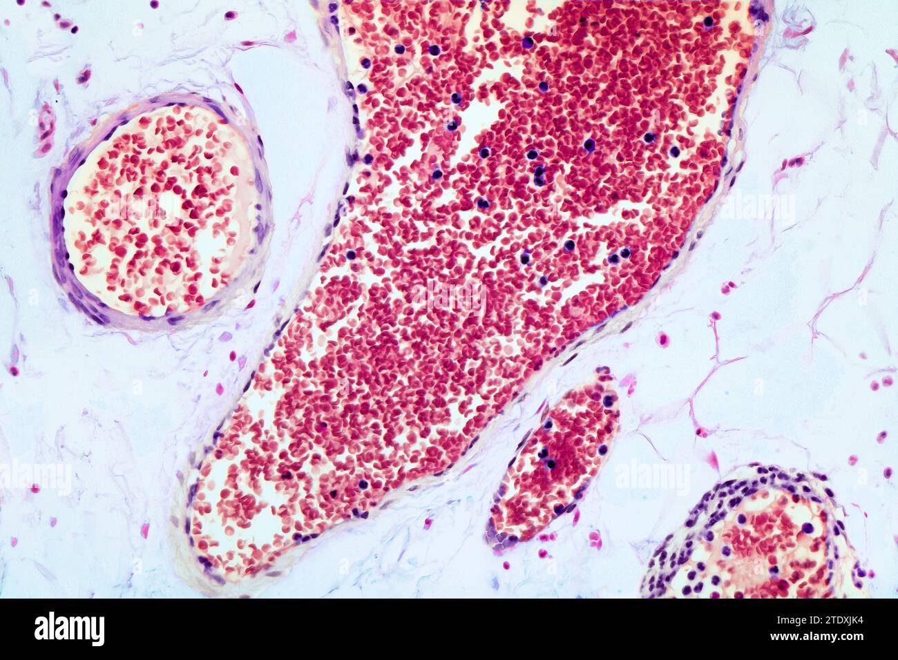 Inflammatory response. Light micrograph of a section through blood ...