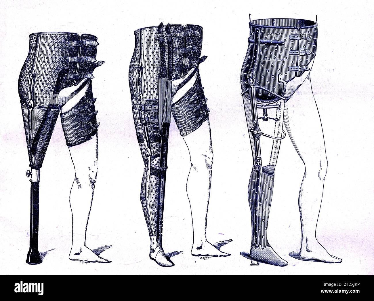 Illustration showing the advances in prosthetic legs before 1907 Stock ...