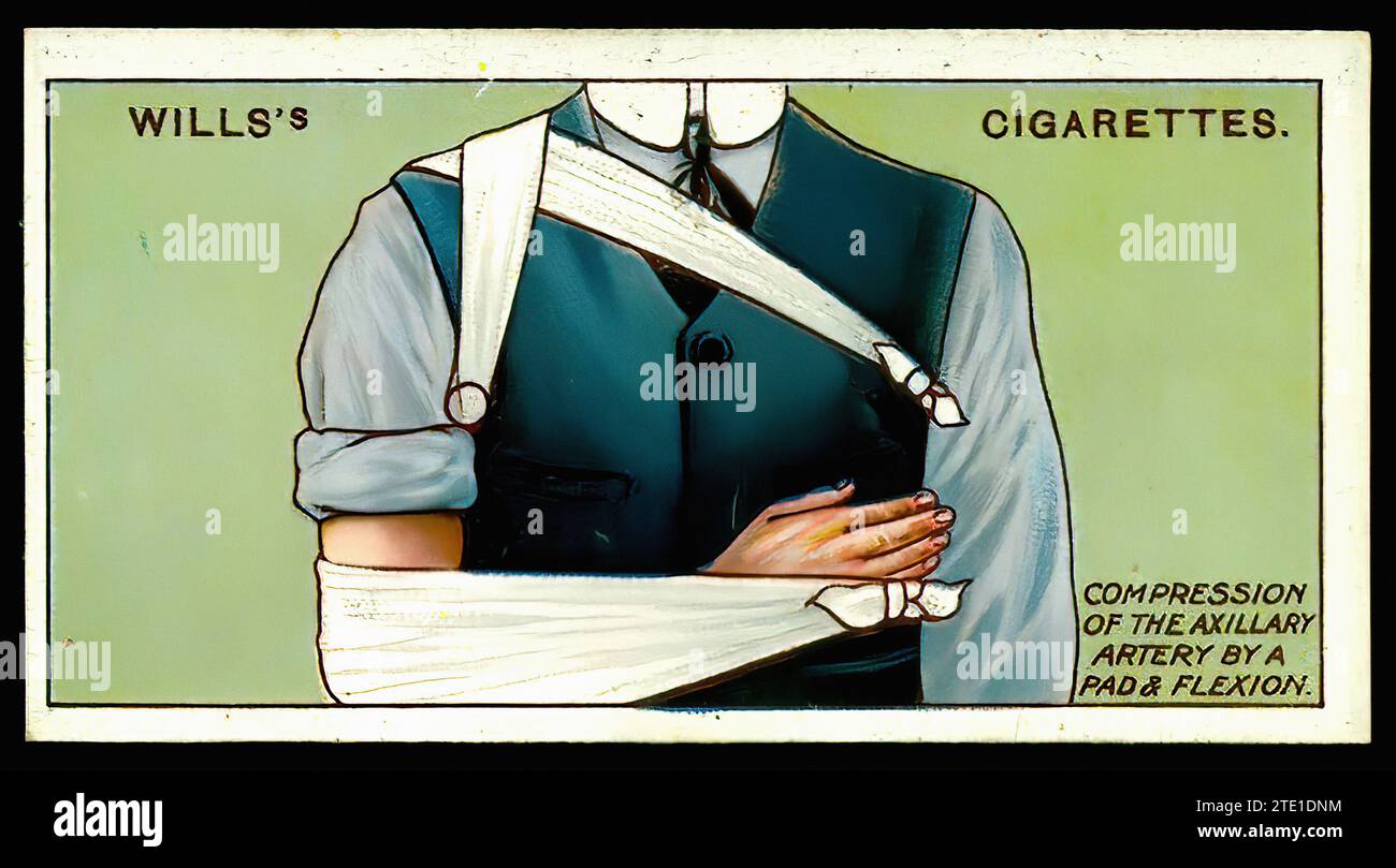 Compression of Axillary Artery - Vintage Cigarette Card Illustration ...