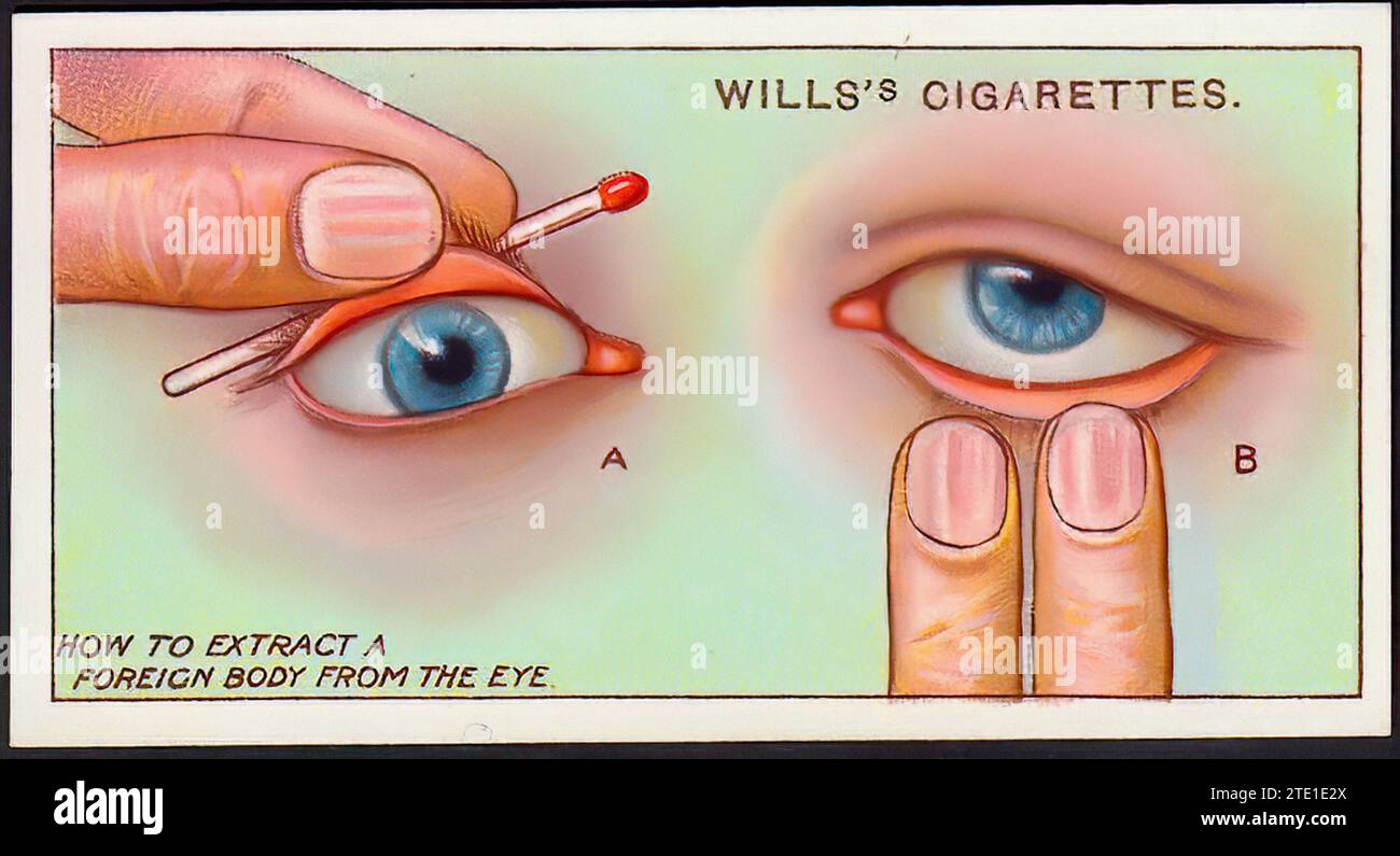 Foreign body eye hi-res stock photography and images - Alamy