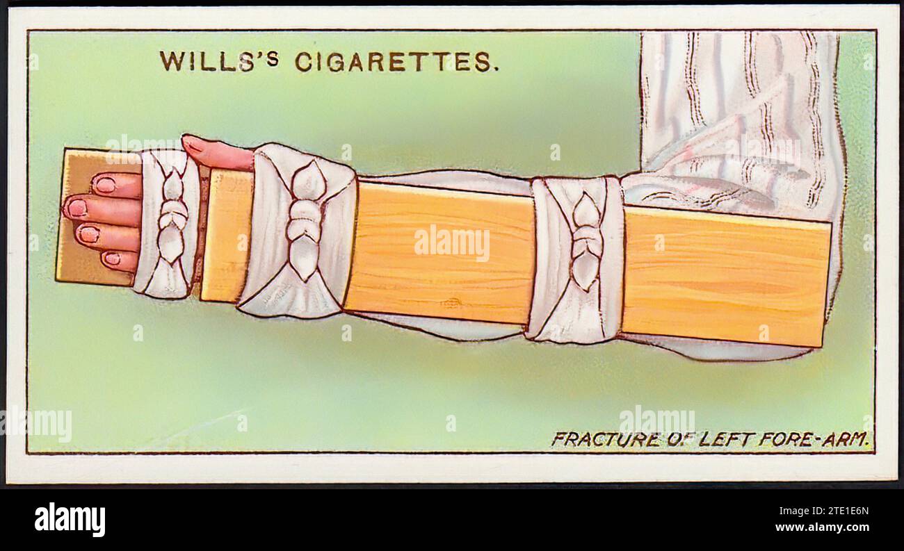 First Aid, Fracture of Left Fore - Arm - Vintage Cigarette Card ...